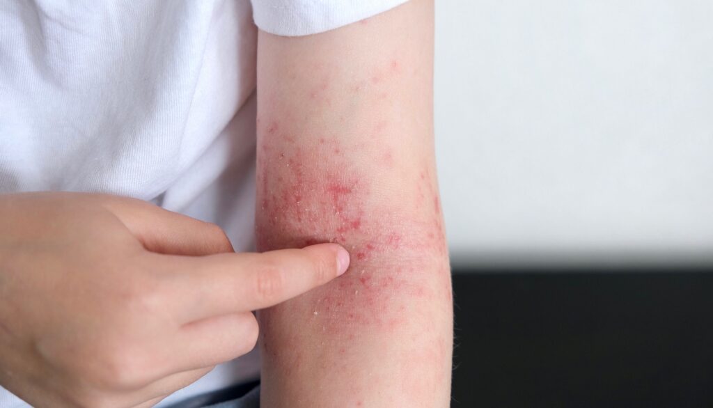 Démarche diagnostique en dermatologie pédiatrique : Pathologies ...